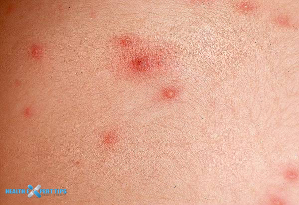 Different Viral Exanthem which you must have to avoid